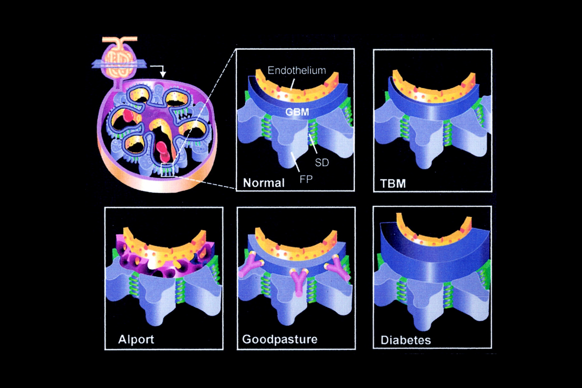 Discoveries in Medicine - The Collagen IV Network in GBM Function and ...