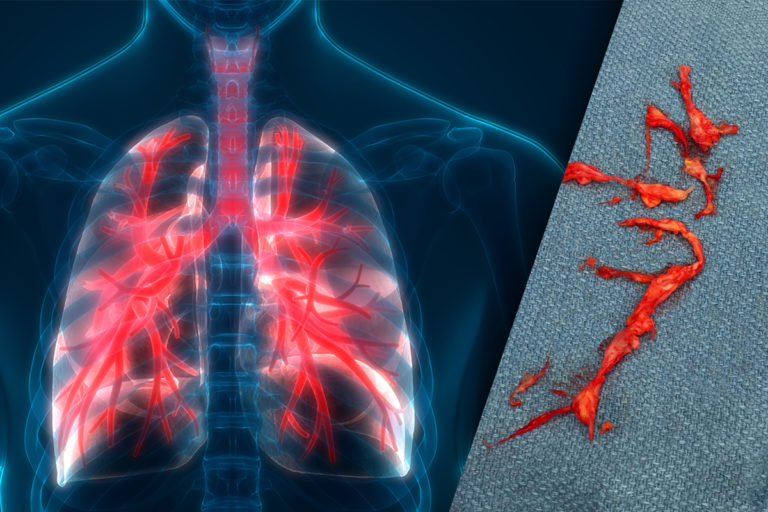 Discoveries in Medicine - Pulmonary Endarterectomy: A Potential Cure ...