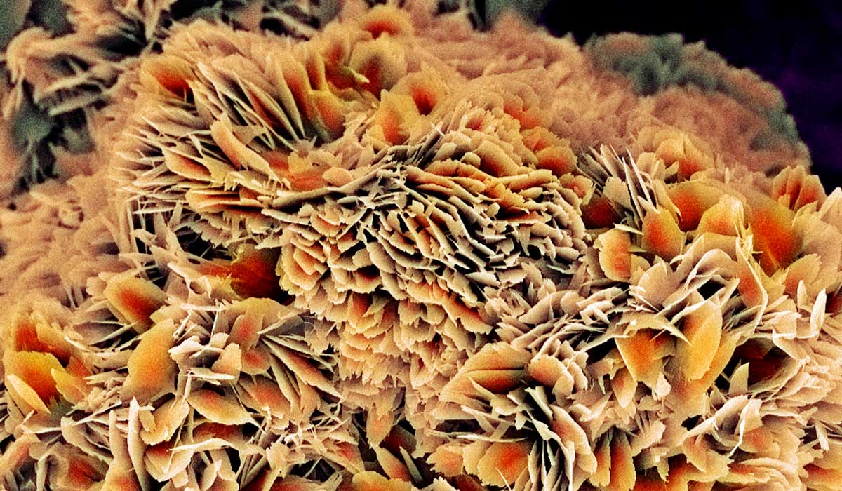 Discoveries in Medicine - Video: Harnessing New Tools to Combat Stone ...