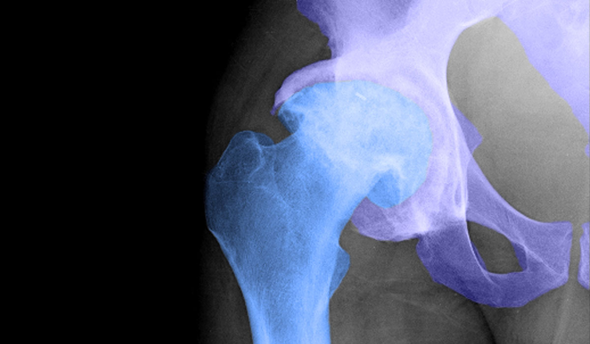 Discoveries in Medicine - New AAOS Guidelines for Hip Osteoarthritis ...