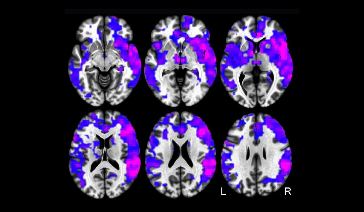 Discoveries in Medicine - Brainstem Connectivity: The Role of ARAS in ...