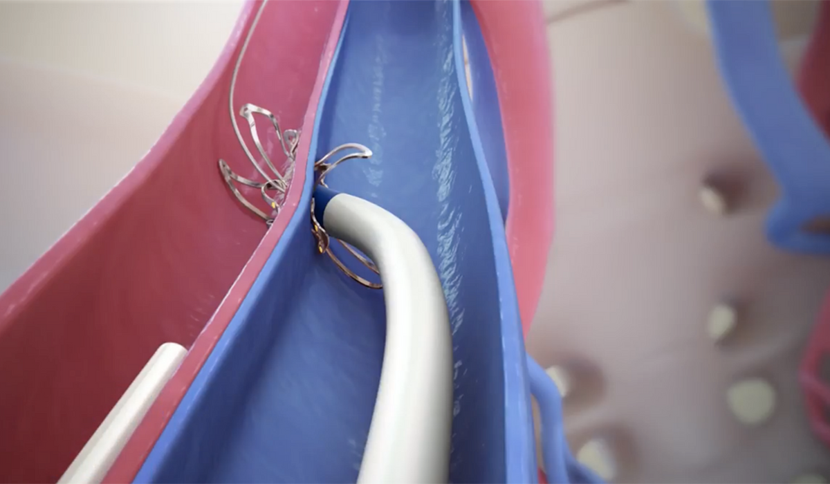 Discoveries in Medicine - Novel Arteriovenous Coupler Therapy for ...