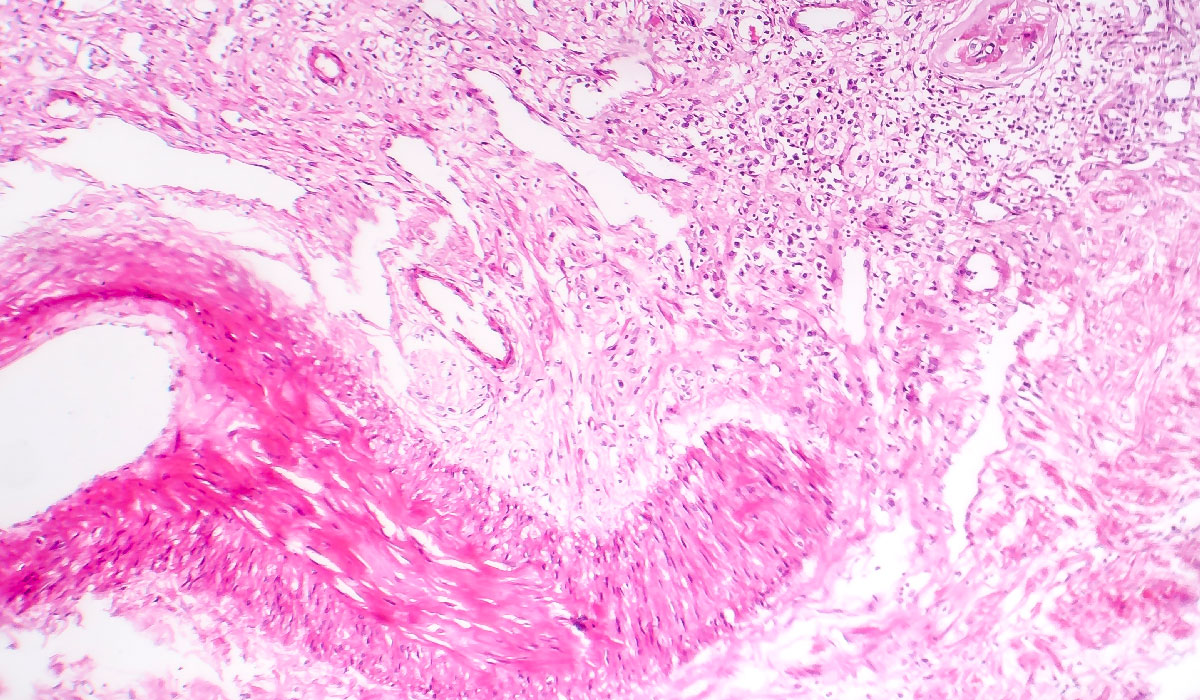 Discoveries in Medicine - Type 2 Diabetes and ESRD: New Research and ...