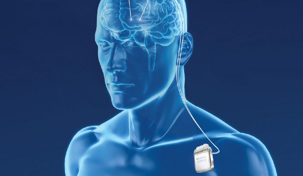 Discoveries In Medicine From Hope To Practice Deep Brain Stimulation