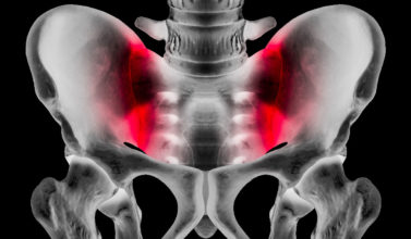 Discoveries in Medicine - Injections for SIJ Pain: New Evidence on ...
