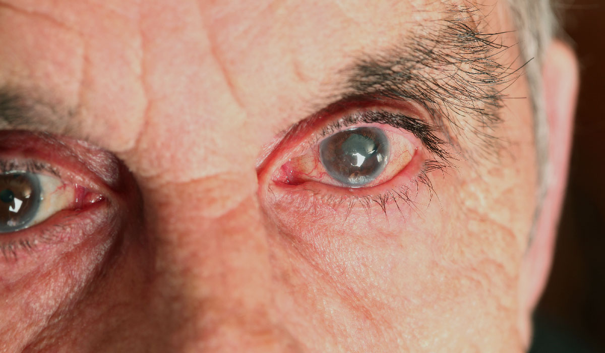 Discoveries in Medicine - Glaucoma: Preventing RGC Degeneration