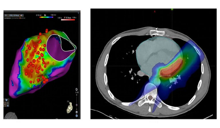 Discoveries in Medicine - Investigating Stereotactic Body Radiation ...