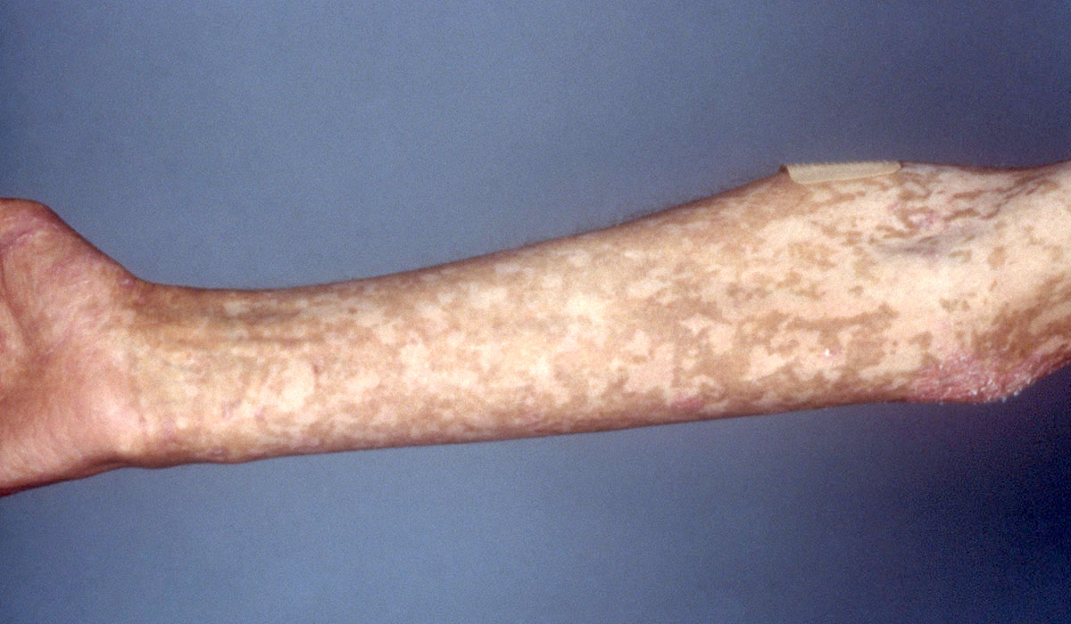 Discoveries in Medicine - FDA Approves Jakafi®, a JAK 1/JAK 2 Inhibitor ...