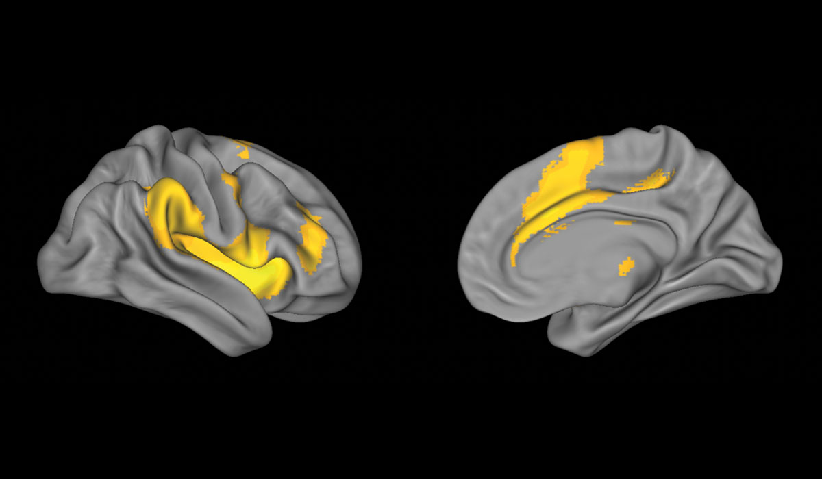 Discoveries in Medicine - Rapid Brain Aging During Psychosis Demands ...