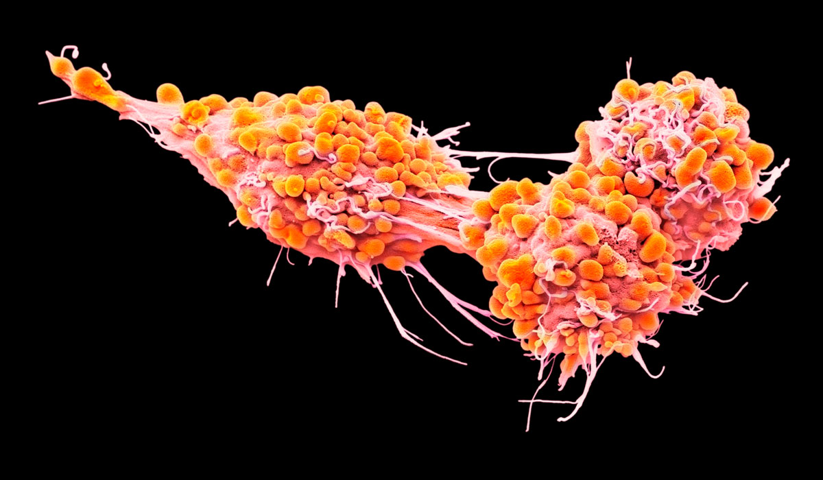 Discoveries in Medicine - New Trial for Platinum-resistant Ovarian Cancer