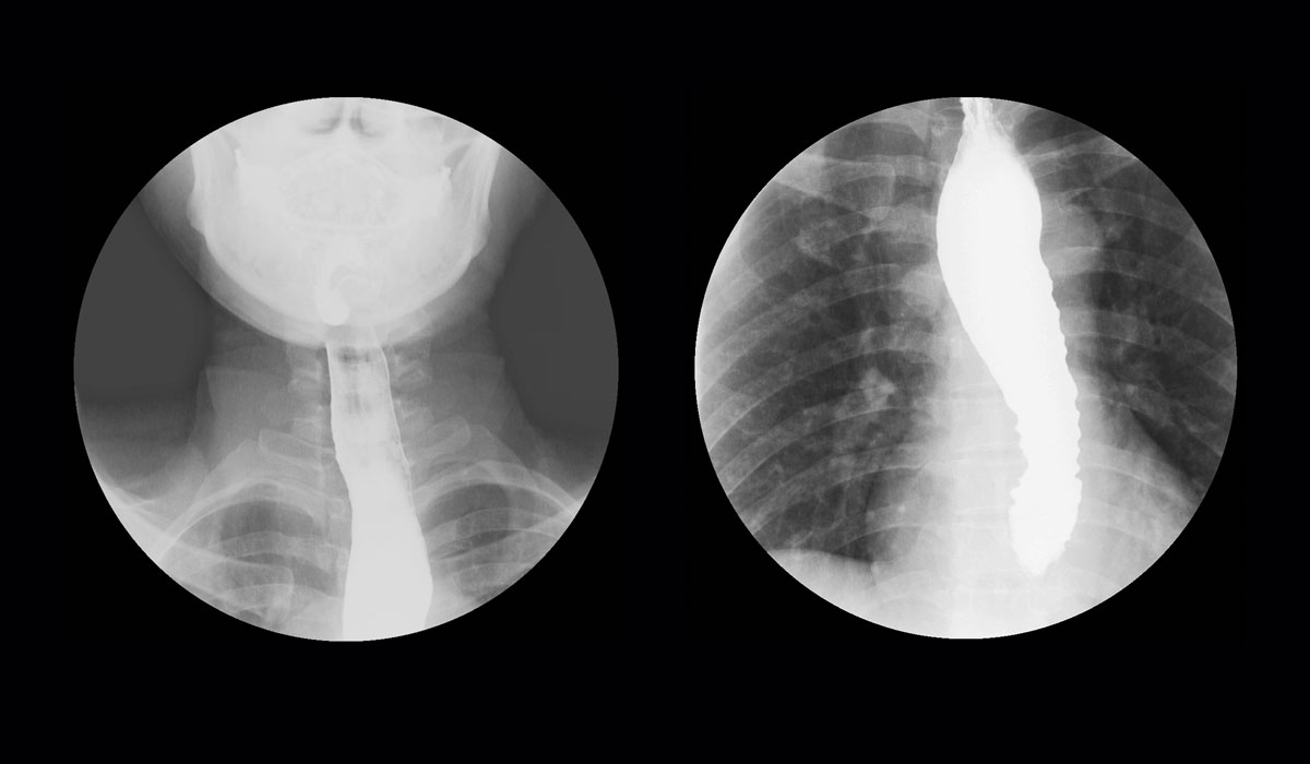 Discoveries in Medicine - Using Biomarkers to Define Achalasia Subtypes