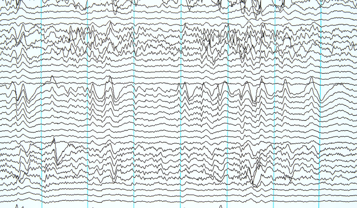 Discoveries in Medicine - SUDEP: Untangling the Causes