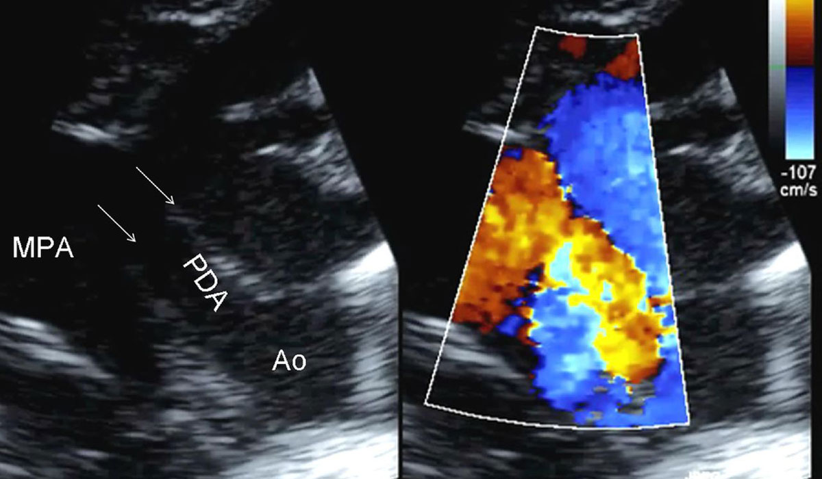 Exploring PDA Therapies on Infant Groups - Vanderbilt Discover