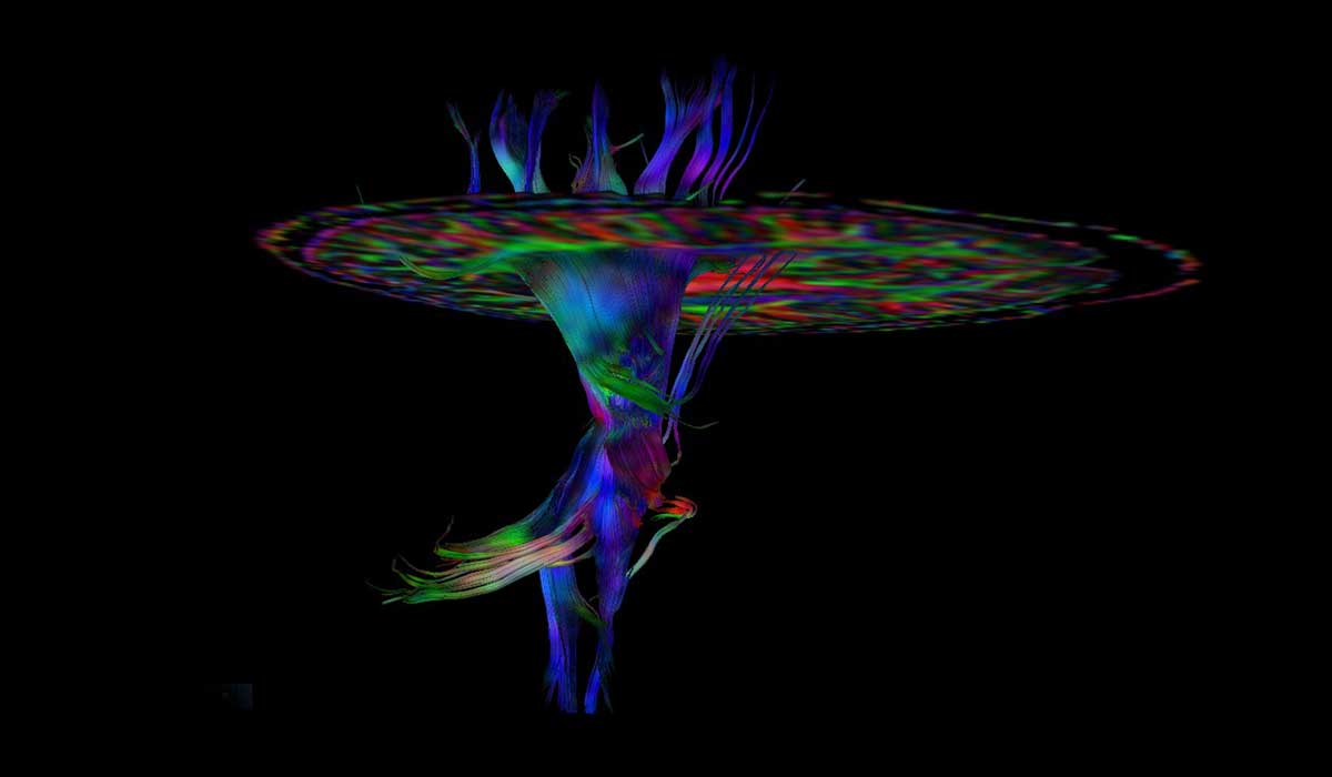 Discoveries in Medicine - Diffusion Tensor Imaging for Peripheral Nerve ...