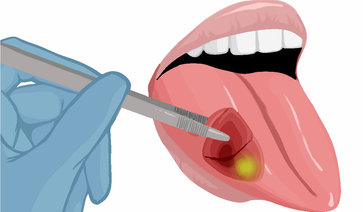 Discoveries in Medicine - Cancer’s Glow Guides More Complete Removal