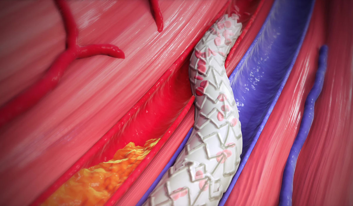Discoveries in Medicine - Vein Arterialization Is Saving ‘Desert Feet’