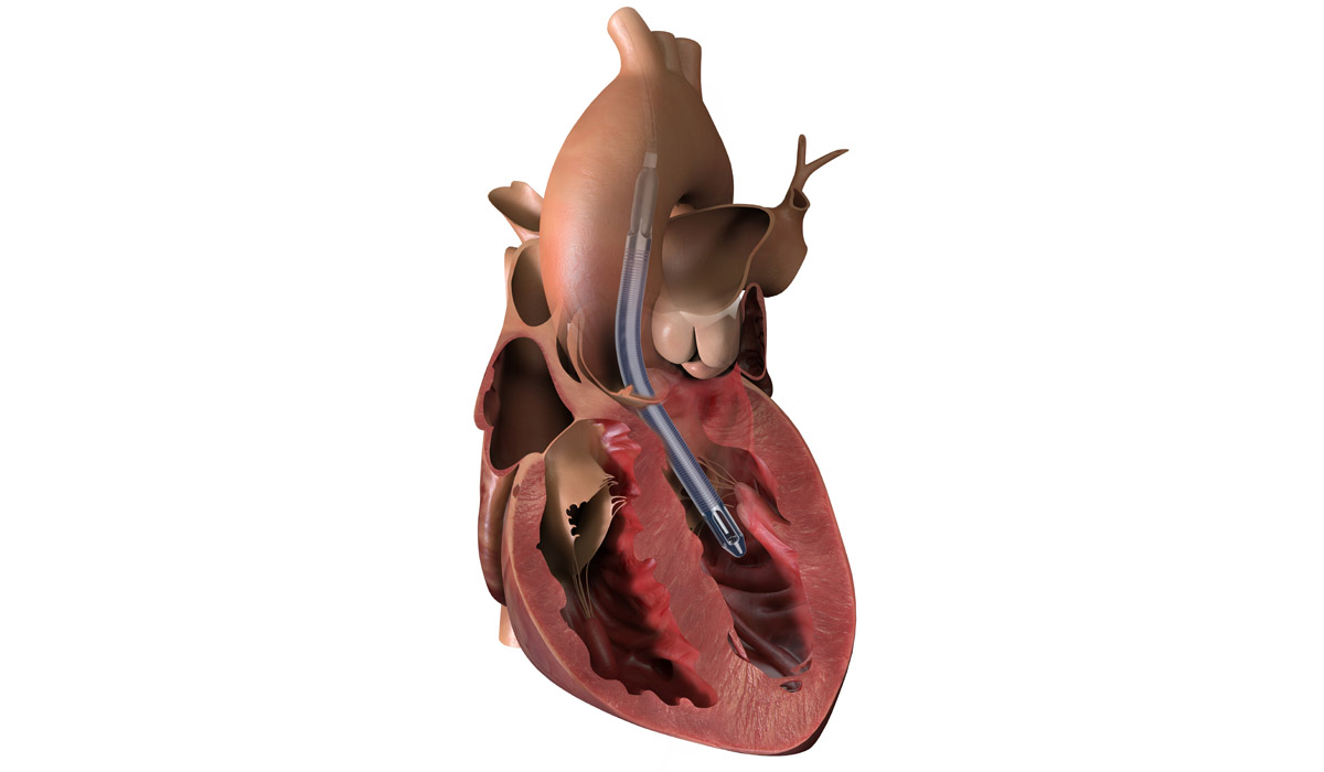 Discoveries in Medicine - Niche Role for New Miniature VAD