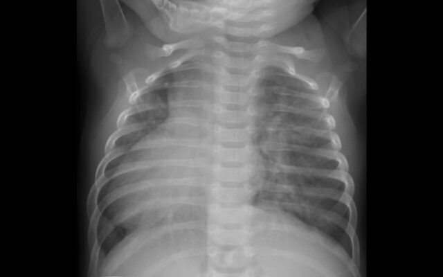 Simplifying Nasal Septal Perforation Repair - Vanderbilt Discover