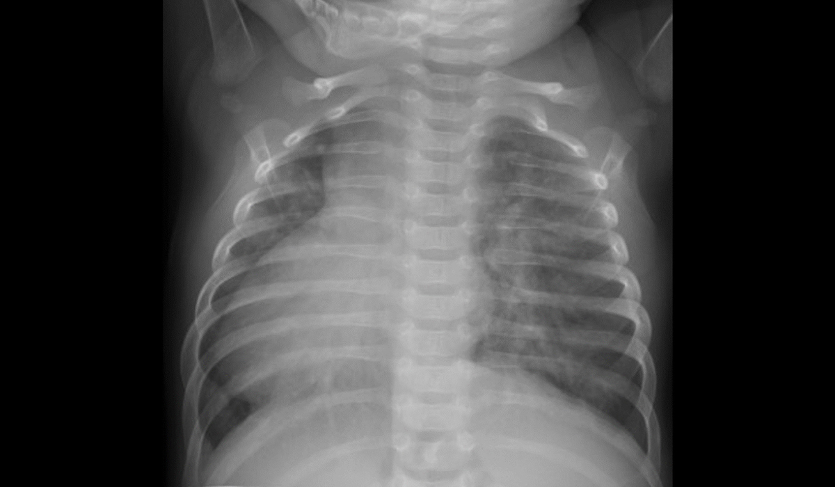 Discoveries in Medicine - Primary Ciliary Dyskinesia Registry Links ...