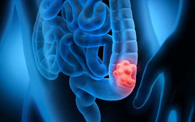 Discoveries in Medicine -Robotic eTEP Hernia Repair Compares to Open ...