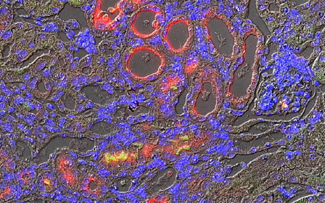 Discoveries in Medicine - Creating the First Implantable Bioartificial ...