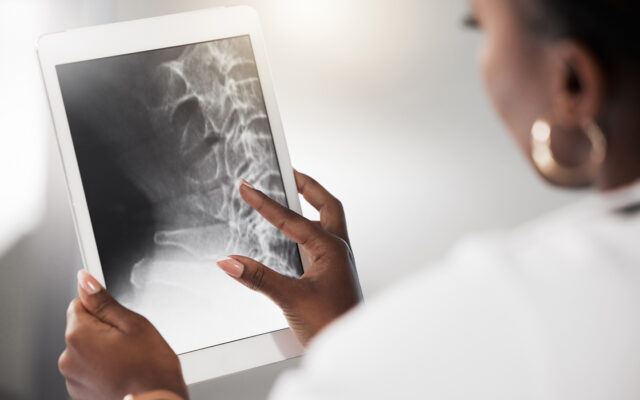 Early Exercise a Benefit to Post-ACDF Surgery - Vanderbilt Discover