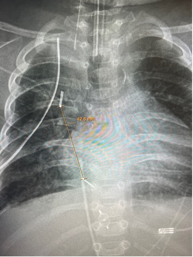 Discoveries in Medicine - Technique Improves Treatment for Esophageal ...