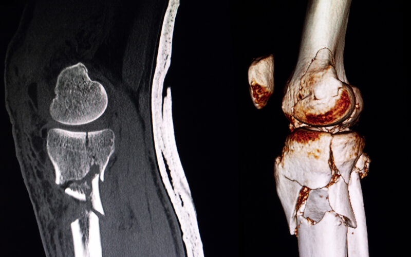 Early Exercise a Benefit to Post-ACDF Surgery - Vanderbilt Discover