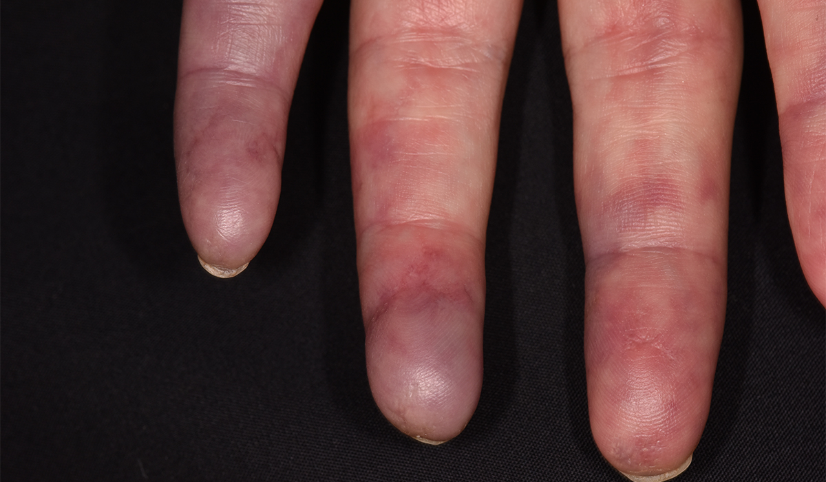 Discoveries in Medicine - Machine Learning Probes Distinctions in Lupus ...