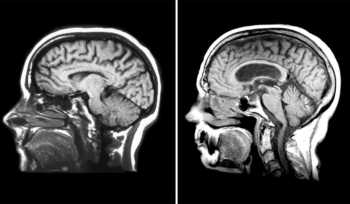 Discoveries in Medicine - Continuum of Care for Cerebrospinal Fluid ...